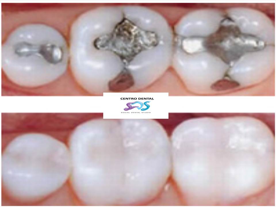 Información sobre la amalgama dental - Clínica Dental Chamberí