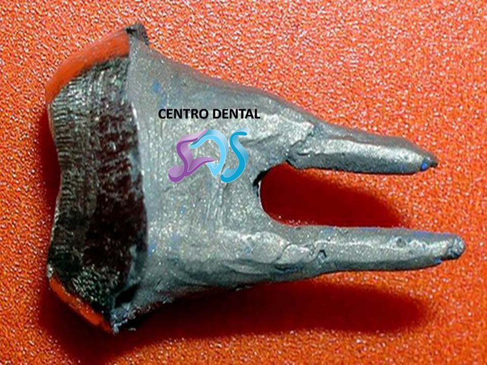 PERNO MUÑON COLADO - Clínica dental en Chamberí | Dentista SDS en ...